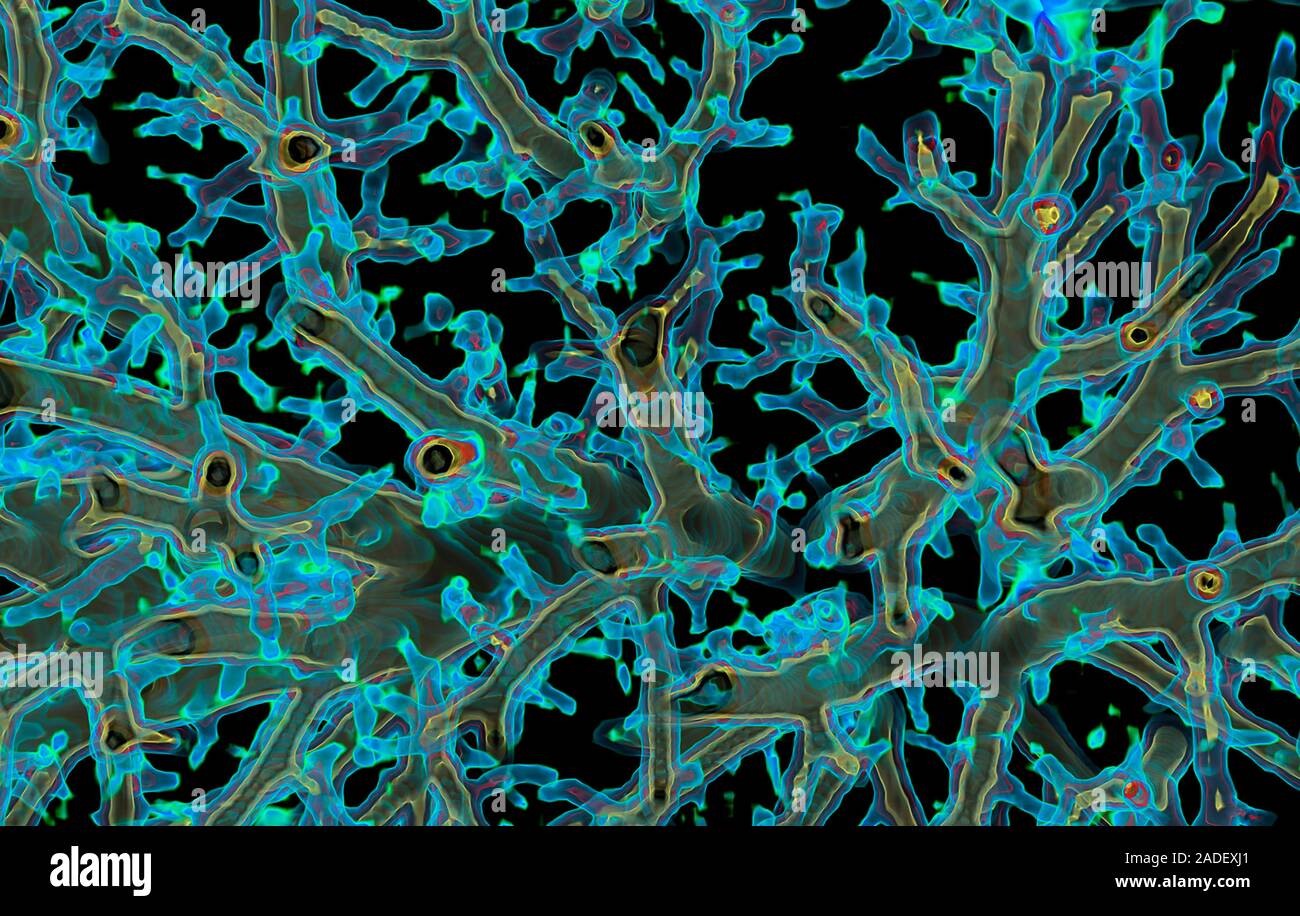 Lung airways, 3D coloured computed tomography (CT) scan. The lung ...
