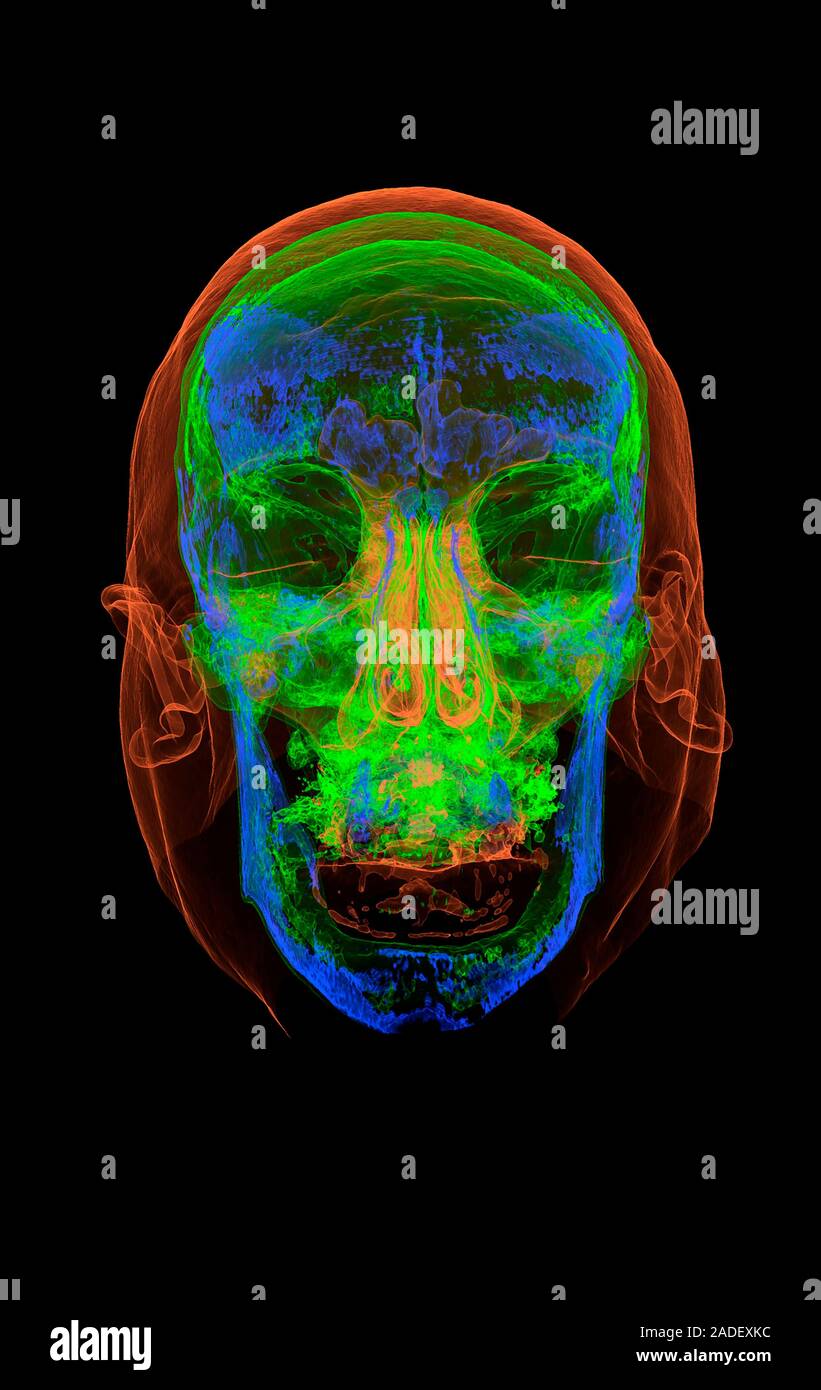 Head and skull. Coloured 3D computed tomography (CT) scan of a frontal ...