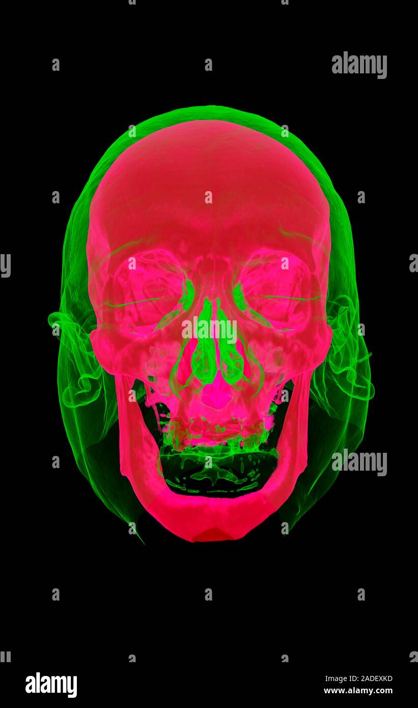 Head and skull. Coloured 3D computed tomography (CT) scan of a frontal ...