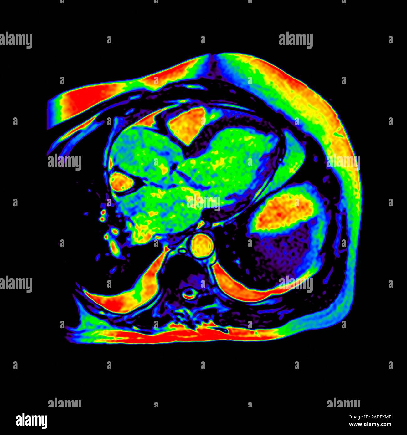 Heart valve insufficiency. Coloured magnetic resonance imaging (MRI ...