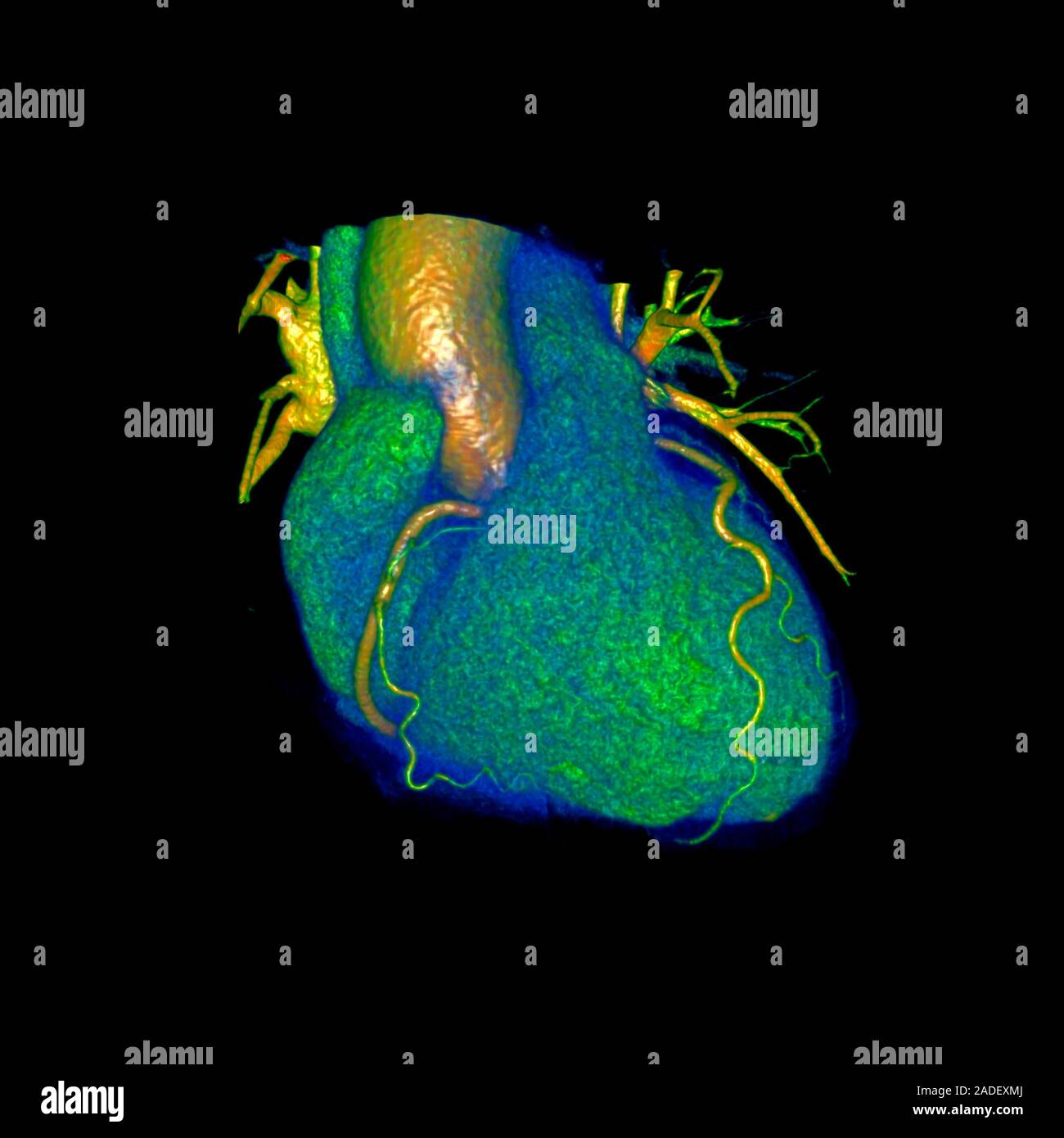 Coronary artery disease. Coloured 3D computed tomography (CT) scan showing atherosclerosis of a ...