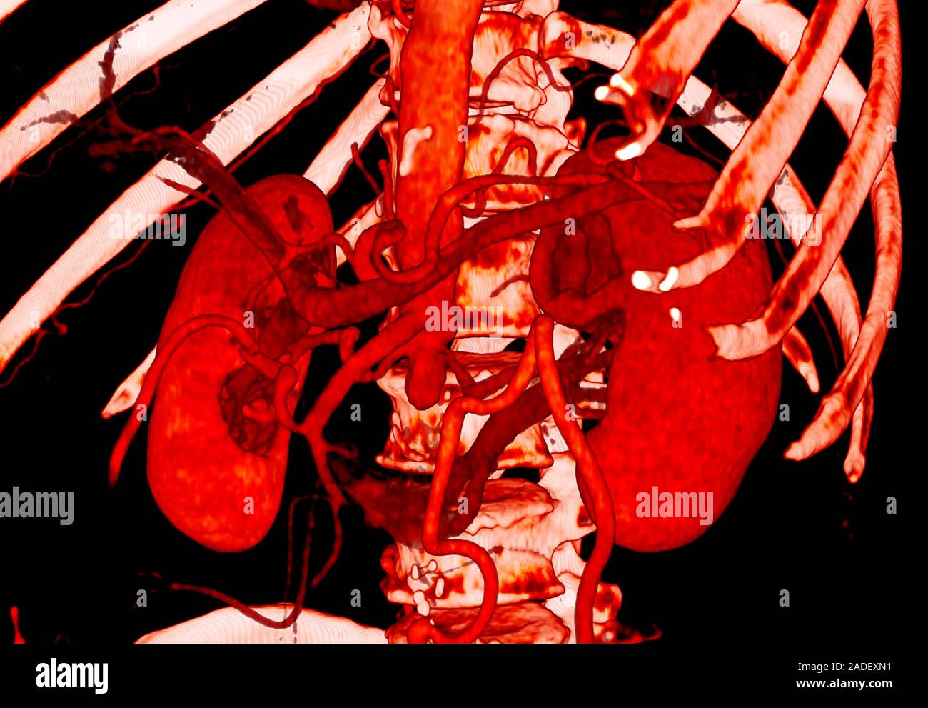 Aortoiliac occlusive disease. Coloured 3D computed tomography (CT) scan ...