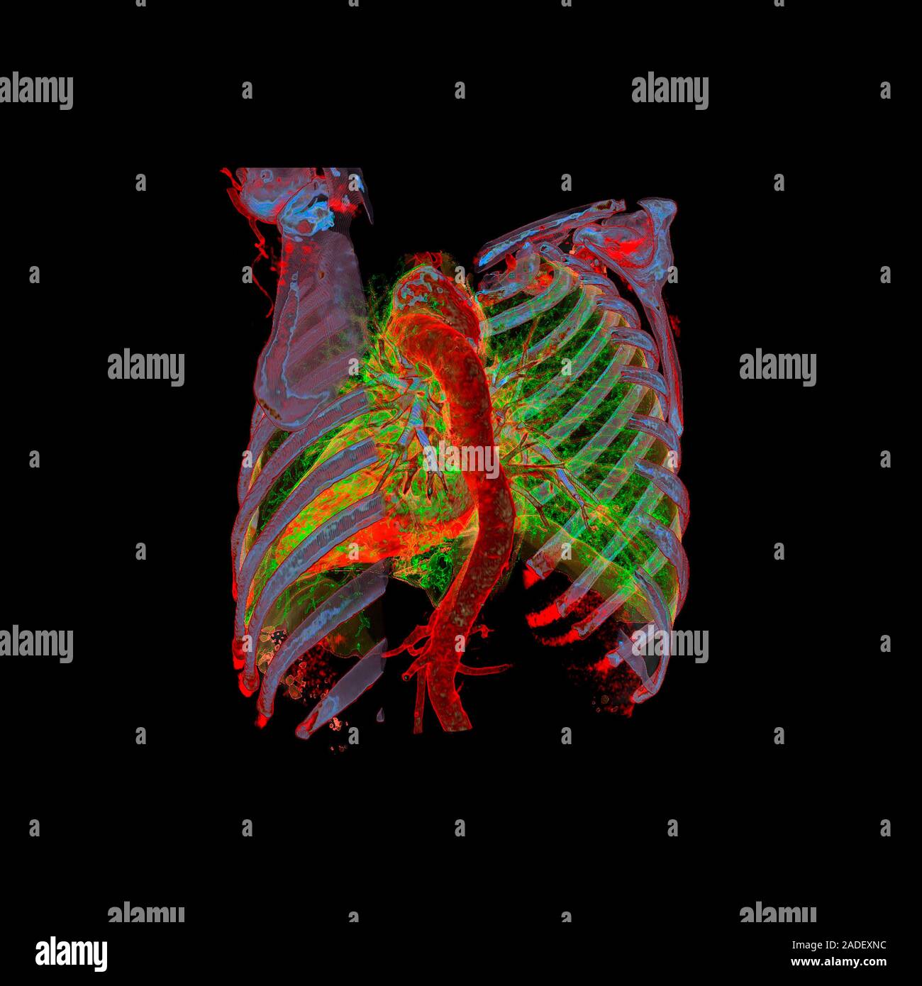 Aortic aneurysm. 3D computed tomography (CT) scan of part of the aorta ...