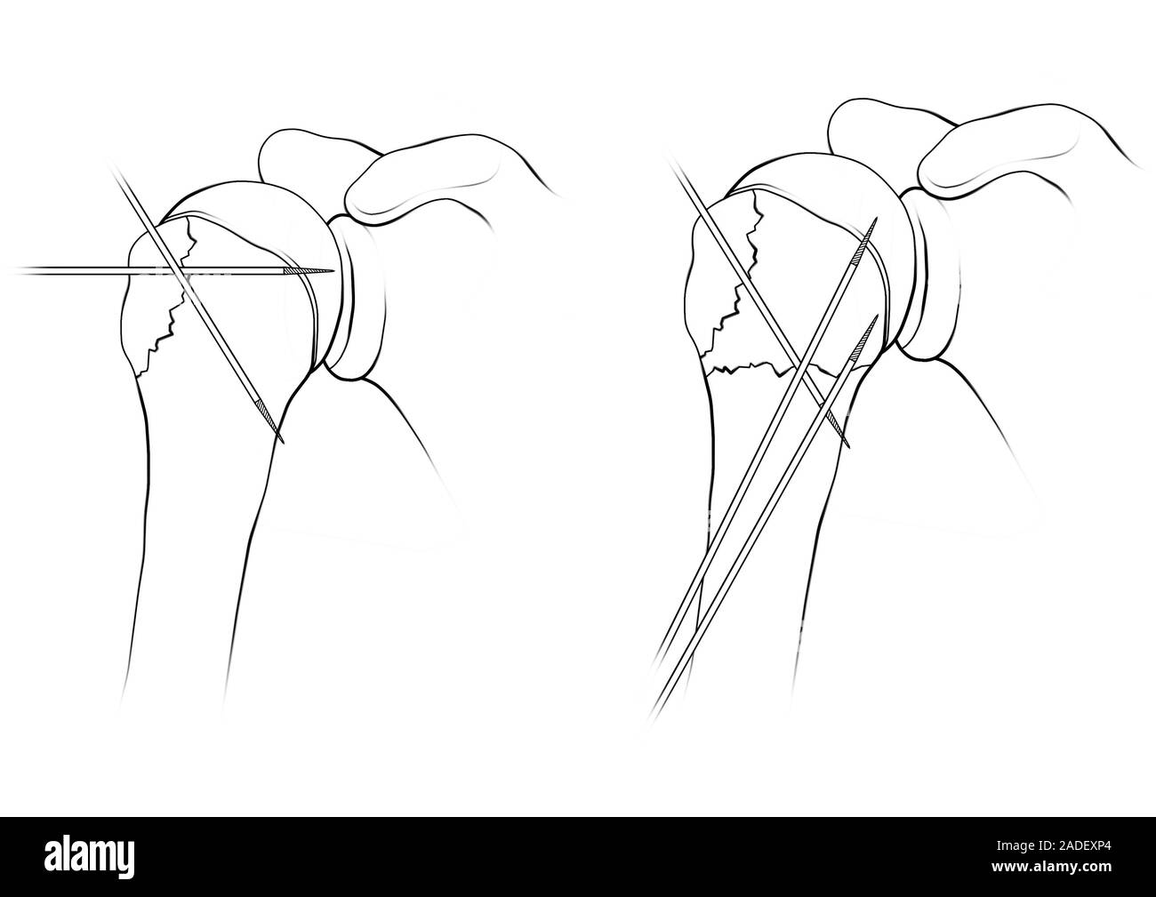 Kirschner wires in shoulder fracture surgery, illustration. Kirschner ...