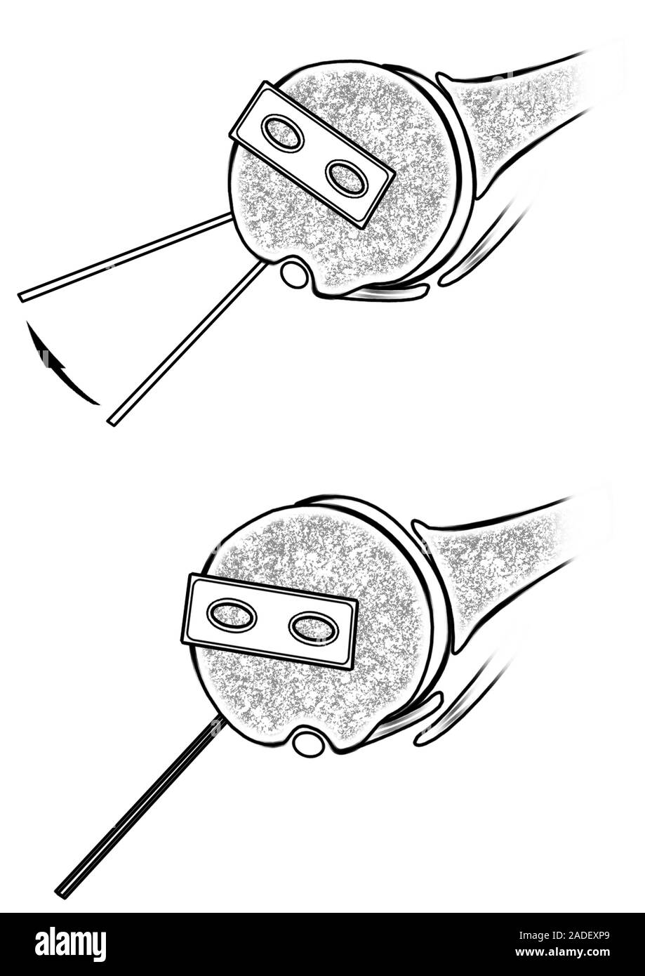 Weber procedure shoulder surgery, illustration. This procedure is a ...