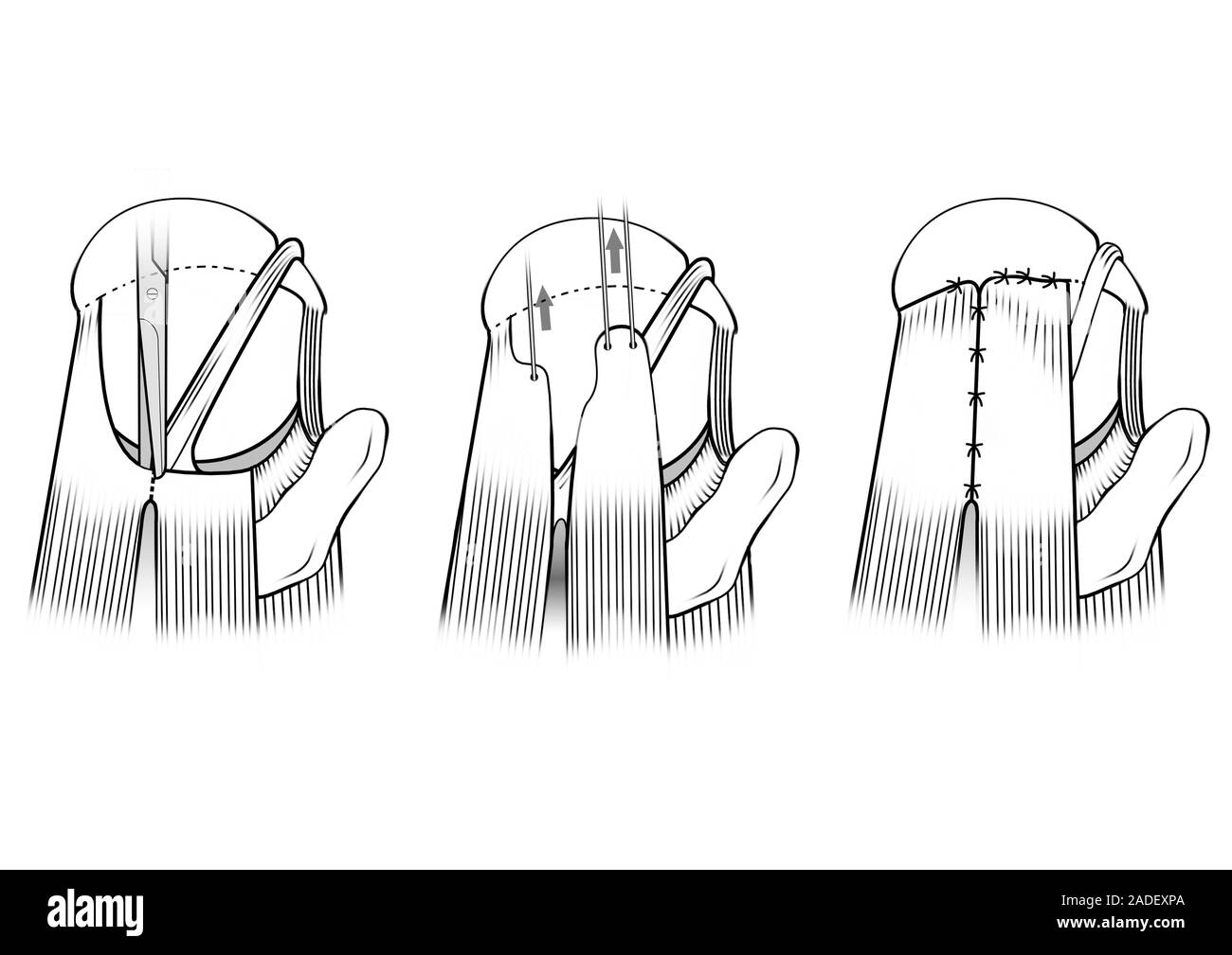 Rotator cuff repair shoulder surgery, illustration. The rotator cuff is ...