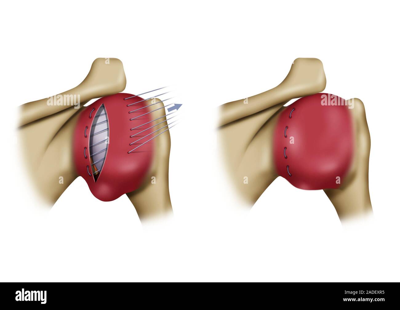Rockwood disorder shoulder surgery, illustration. Rockwood disorder ...