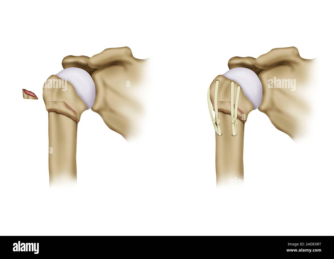 Shoulder bone reduction surgery, illustration. At left, a fragment of ...