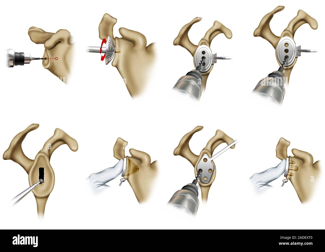 Shoulder implant surgeries, illustration. The implants are being placed ...