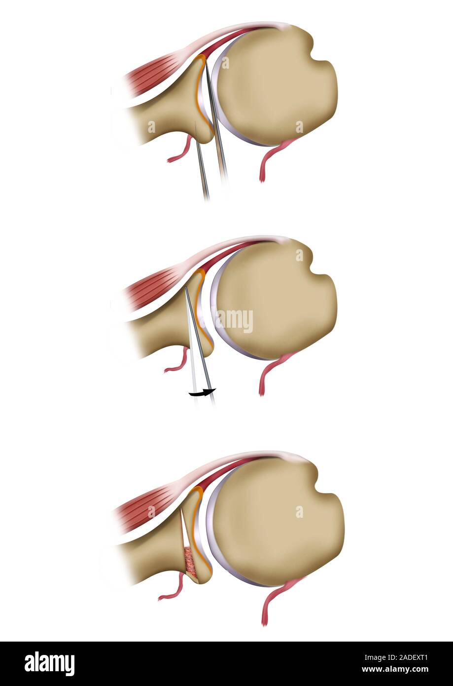 Glenoid osteotomy shoulder surgery, illustration. This operation ...
