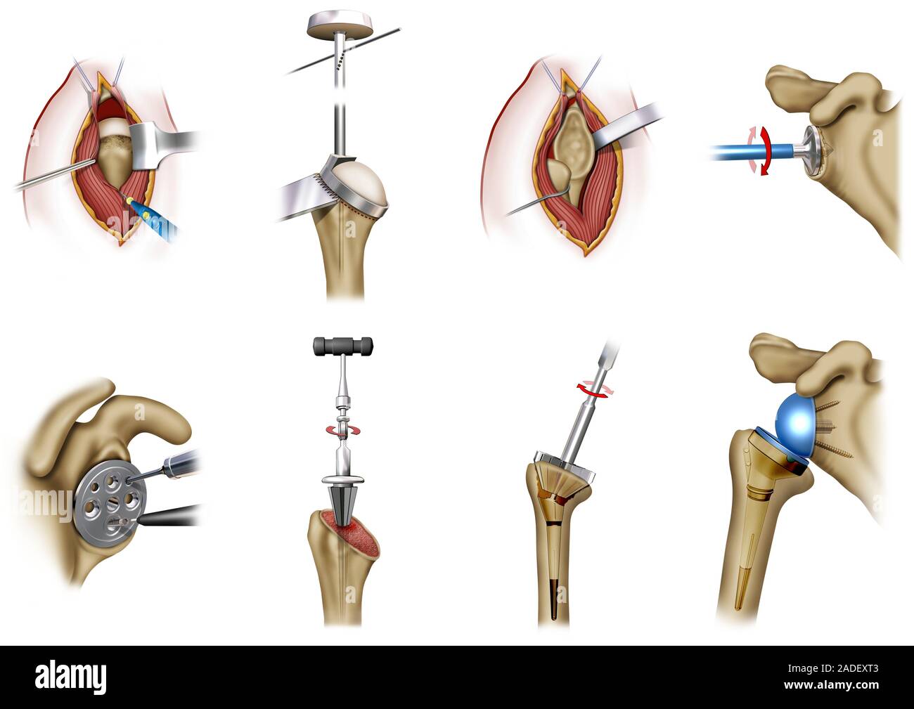 Humeral prosthesis shoulder surgery, illustration. This operation is ...