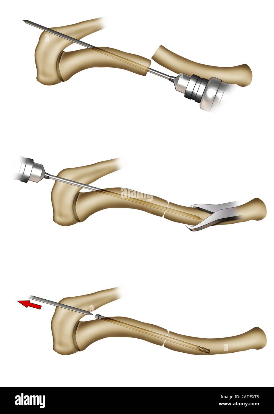 Clavicle fracture repair surgery, illustration. Different procedures ...