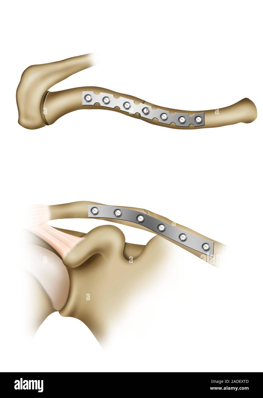 Clavicle fracture repair surgery, illustration. Different procedures ...