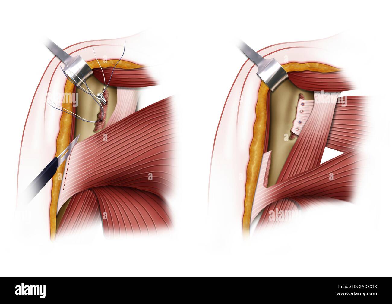 Shoulder muscles surgery, illustration. The muscles being operated on ...