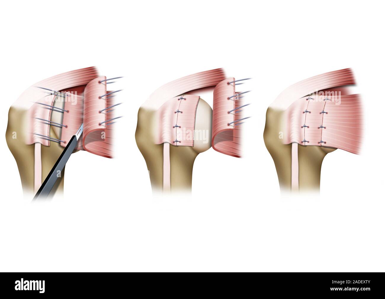 Shoulder muscles surgery, illustration. The muscles being operated on ...