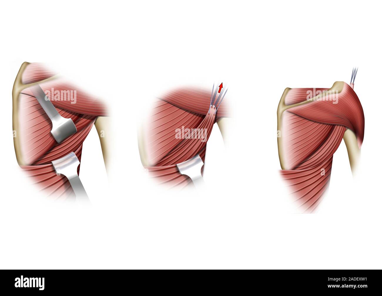 Shoulder muscles surgery, illustration. The muscles being operated on ...