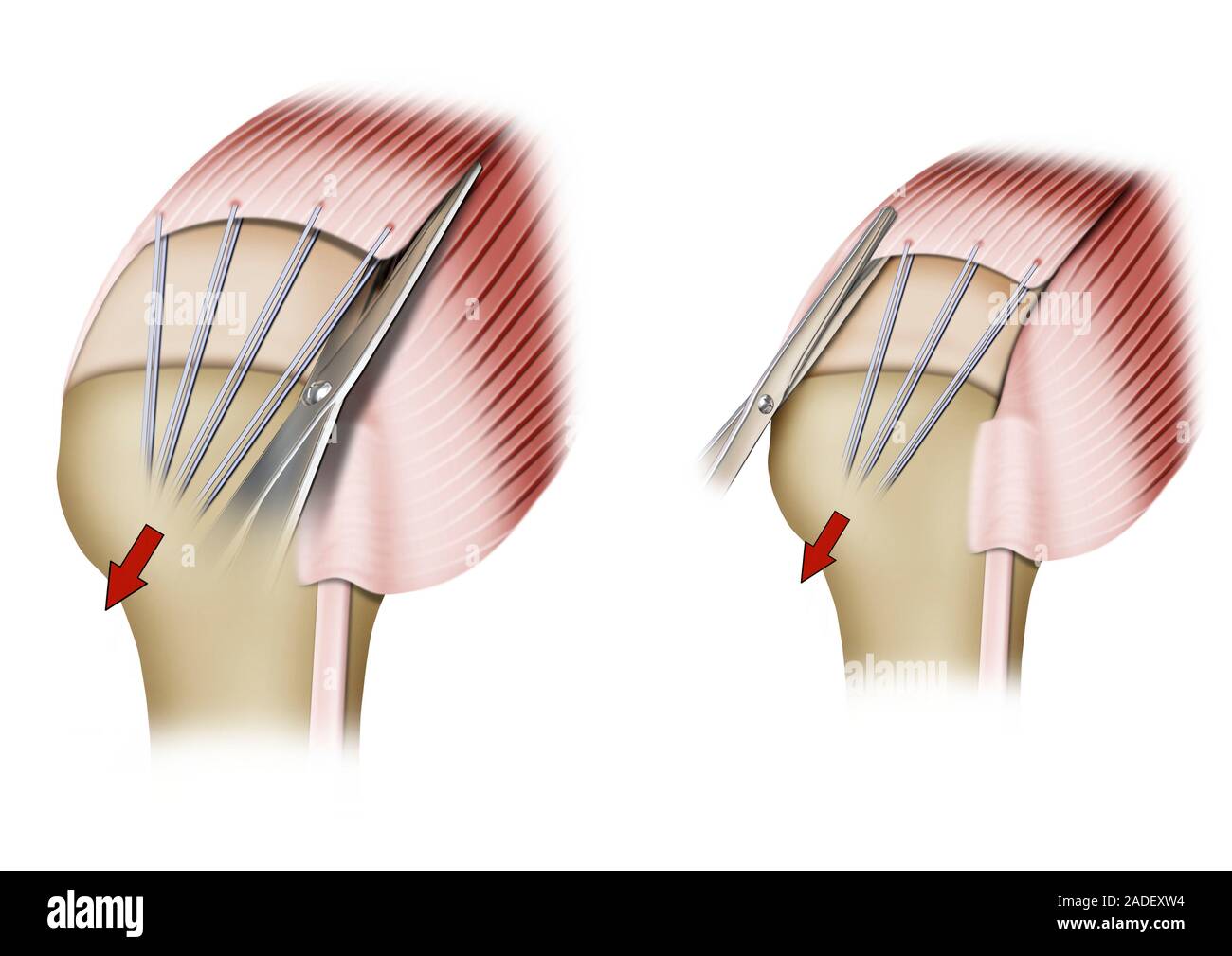 Rotator cuff shoulder surgery, illustration. The rotator cuff is a ...