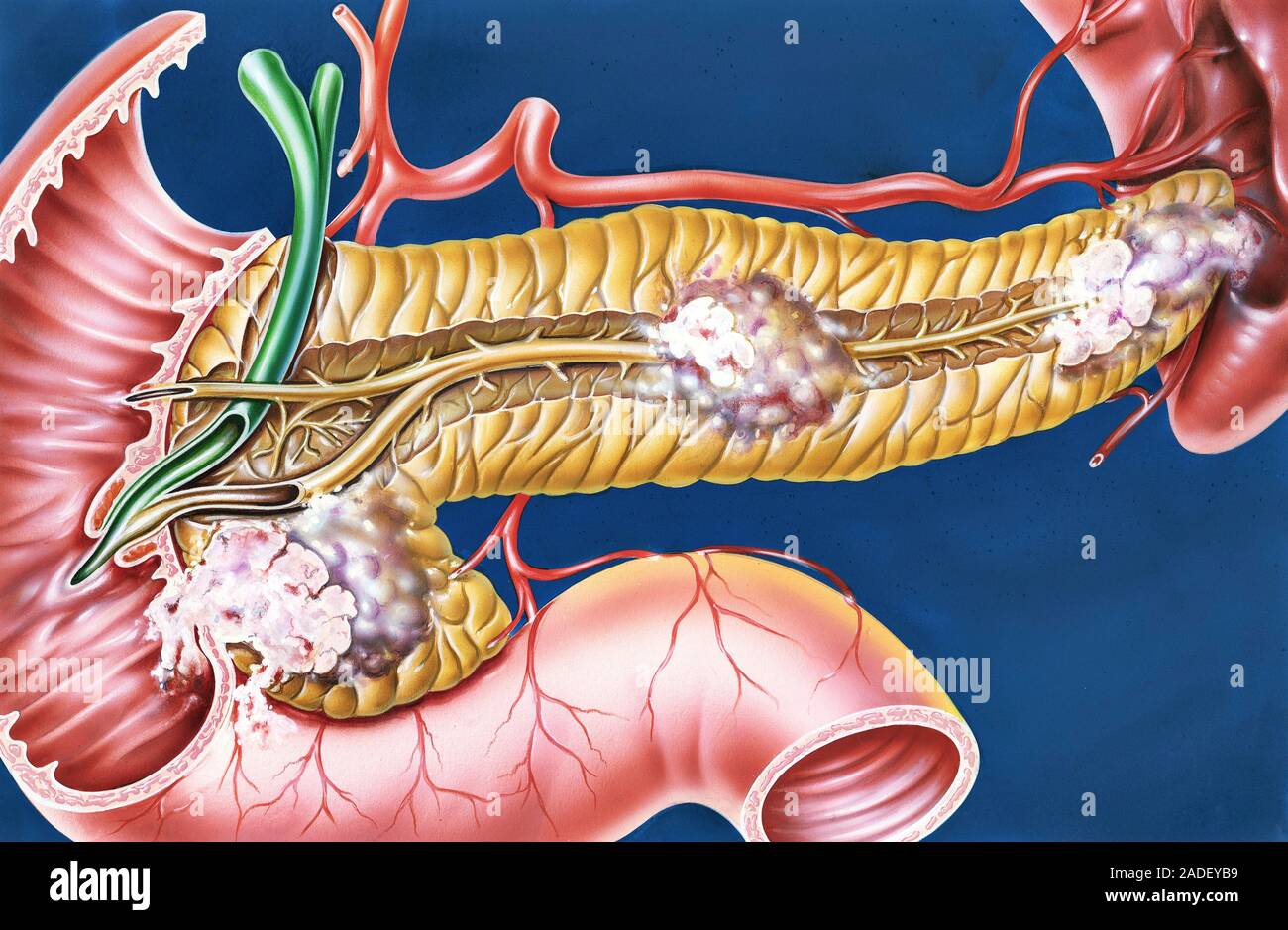 Pancreatic cancers. Computer illustration showing malignant (cancerous ...