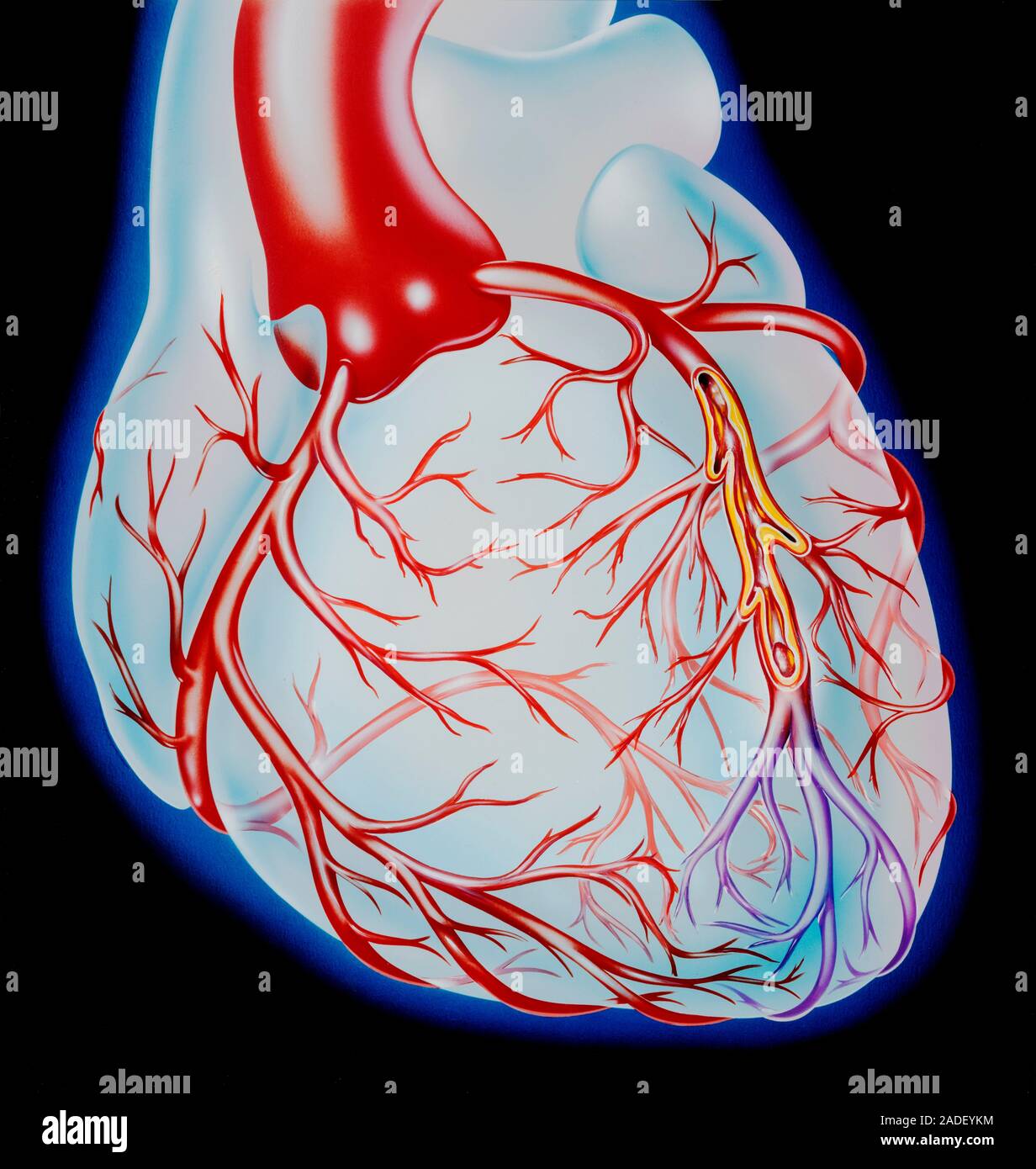 Coronary artery occlusion in heart attack. Illustration of a human ...