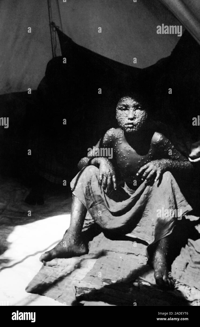 Smallpox in Bangladesh, 1970s. 12-year-old girl with a severe case of ...