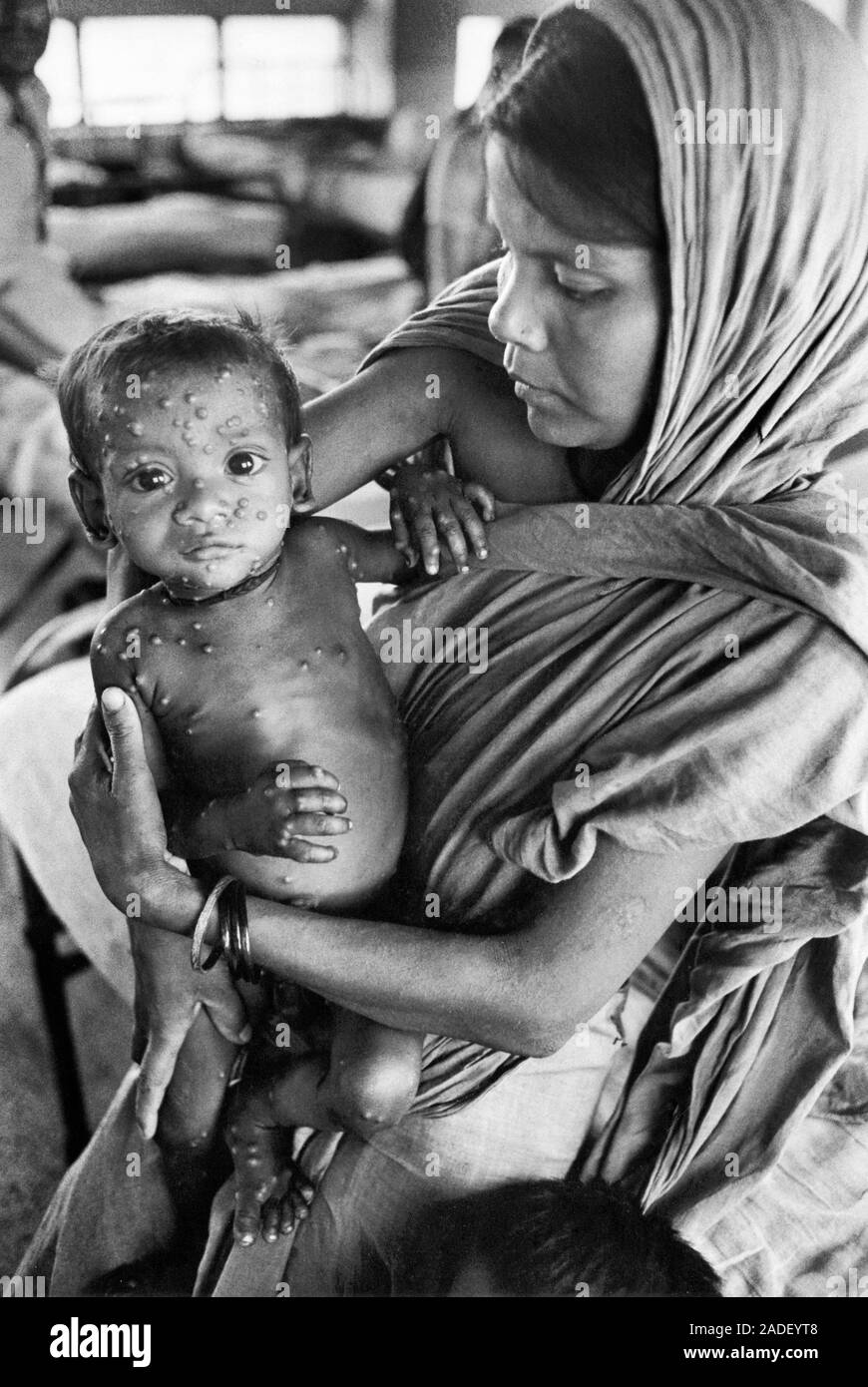 Smallpox in Bangladesh, 1970s. Mother caring for her child who has ...