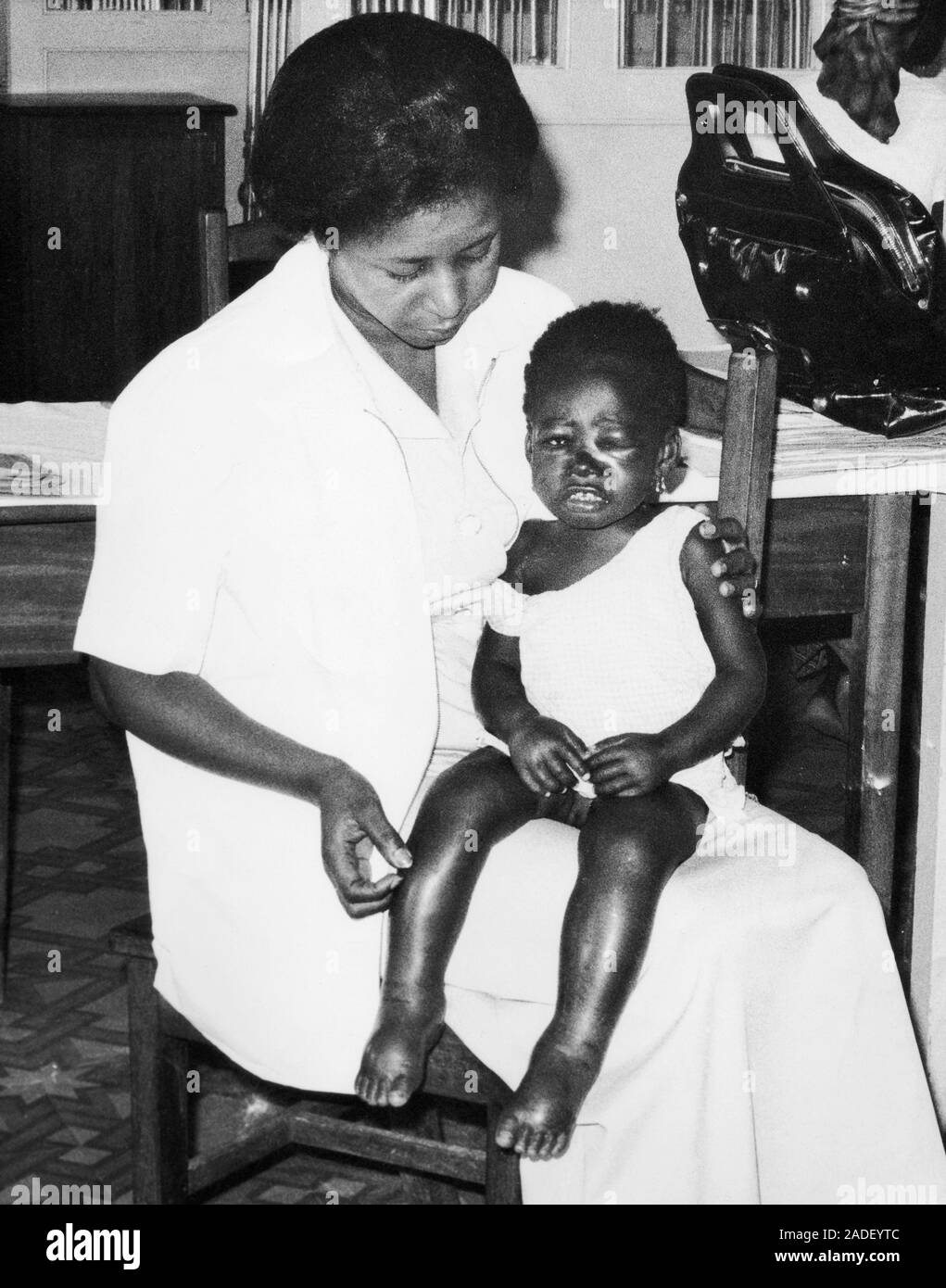 Child with kwashiorkor in Ghana. This disorder is a form of severe ...