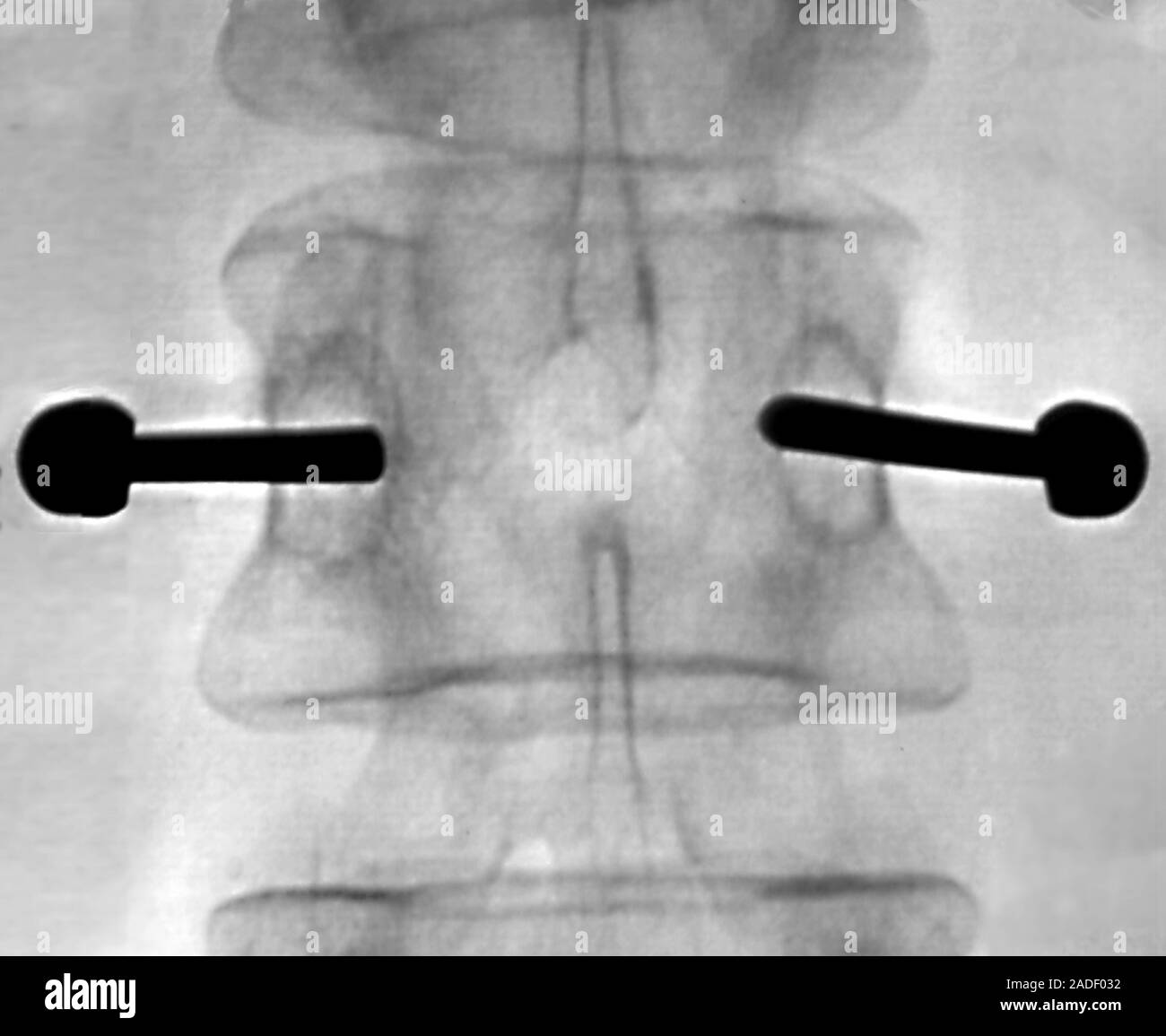 Vertebral augmentation in metastatic cancer. X-ray of a section through ...