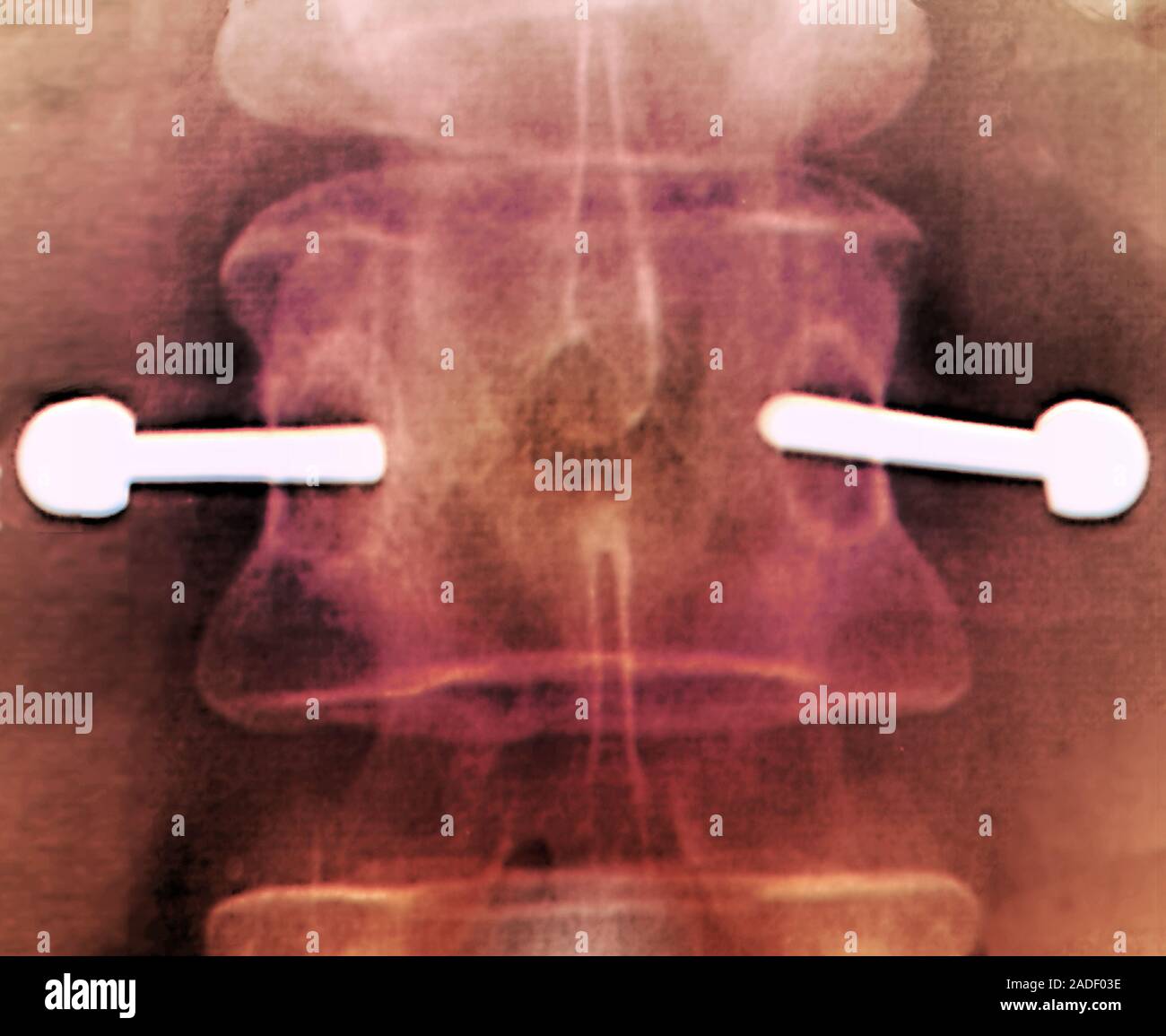Vertebral augmentation in metastatic cancer. Coloured X-ray of a ...