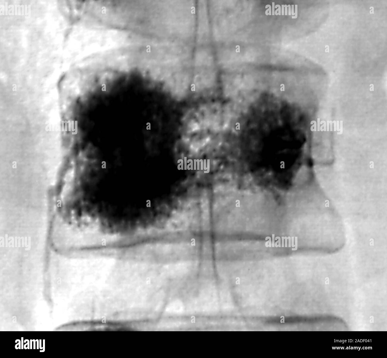 Vertebral augmentation in metastatic cancer. X-ray of a section through ...