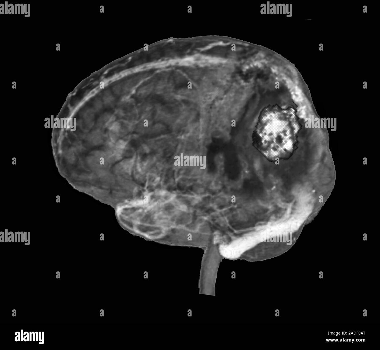 Brain tumour. Magnetic resonance imaging (MRI) scan of a section through the brain of a 60-year ...