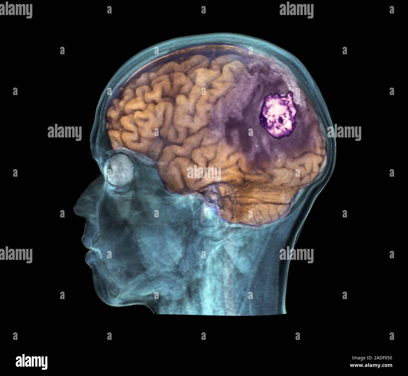 Brain tumour. Coloured 3-dimensional magnetic resonance imaging (MRI) scan of the brain of a 60 ...