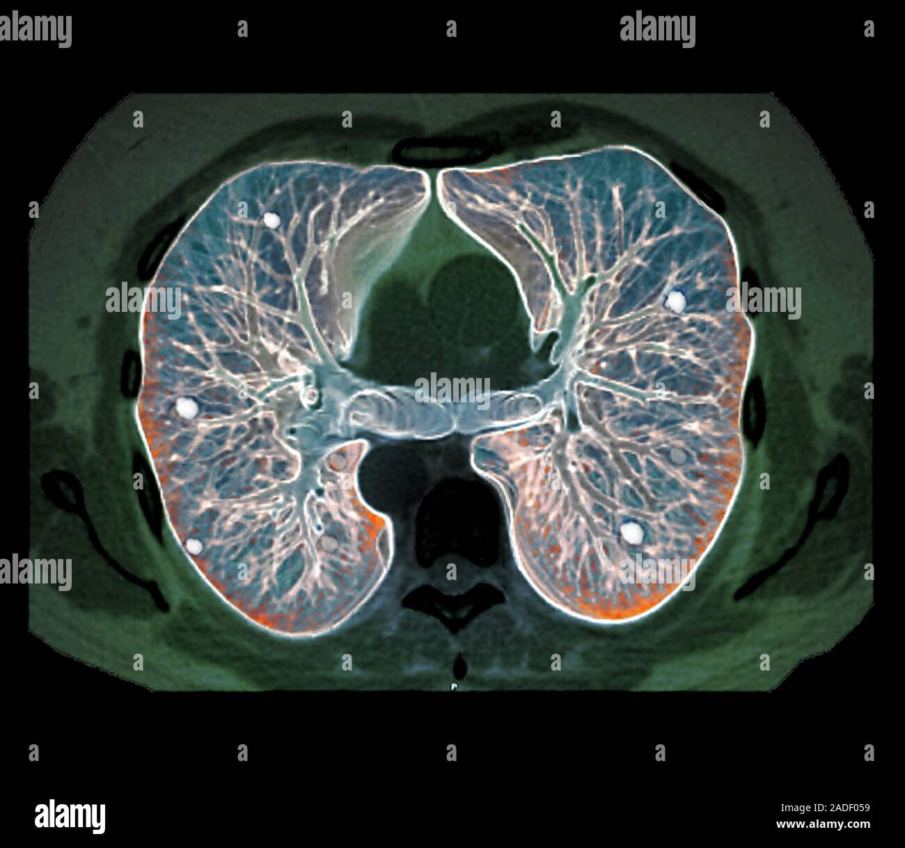 Secondary lung cancer. Coloured 3D computed tomography (CT) scan of a section through the lungs ...