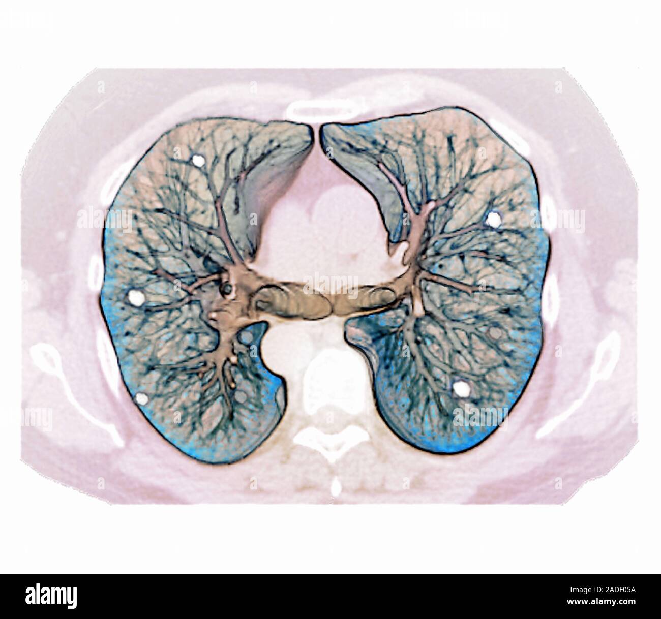 Secondary lung cancer. Coloured 3D computed tomography (CT) scan of a section through the lungs ...