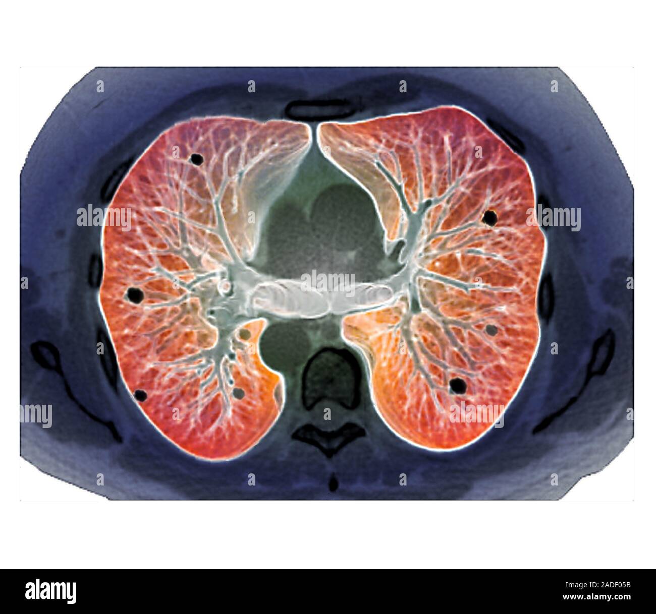 Secondary lung cancer. Coloured 3D computed tomography (CT) scan of a section through the lungs ...