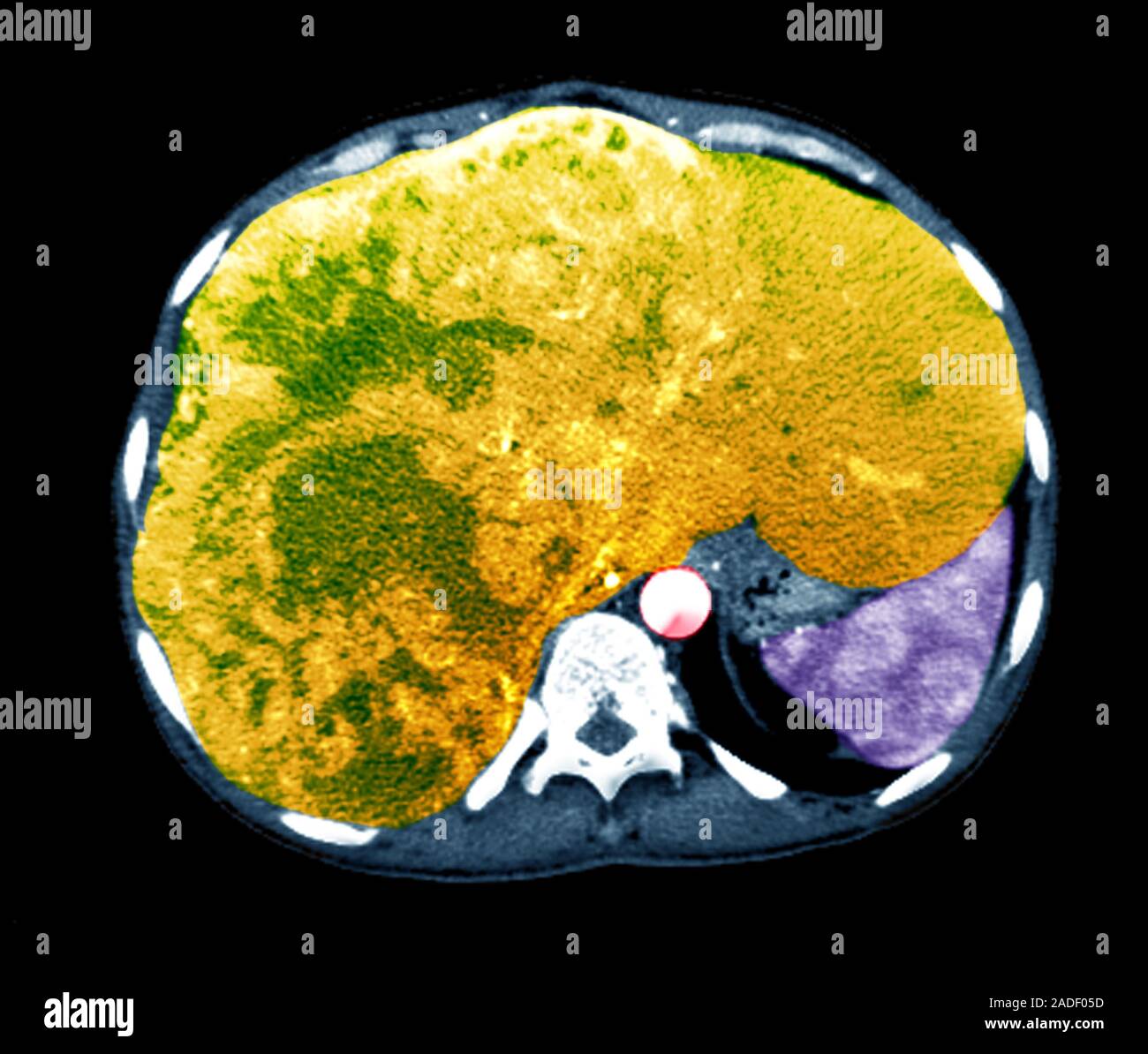 Liver cancer. Coloured computed tomography (CT) scan of a section through the abdomen of a 53 ...