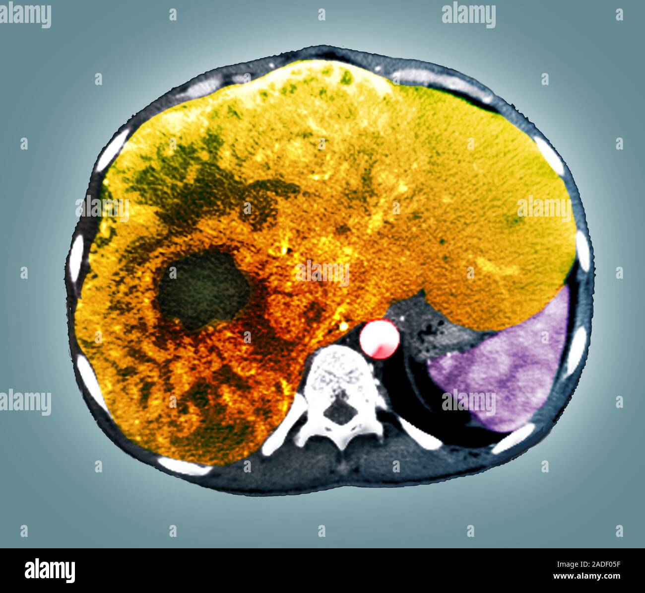 Liver cancer. Coloured computed tomography (CT) scan of a section through the abdomen of a 53 ...