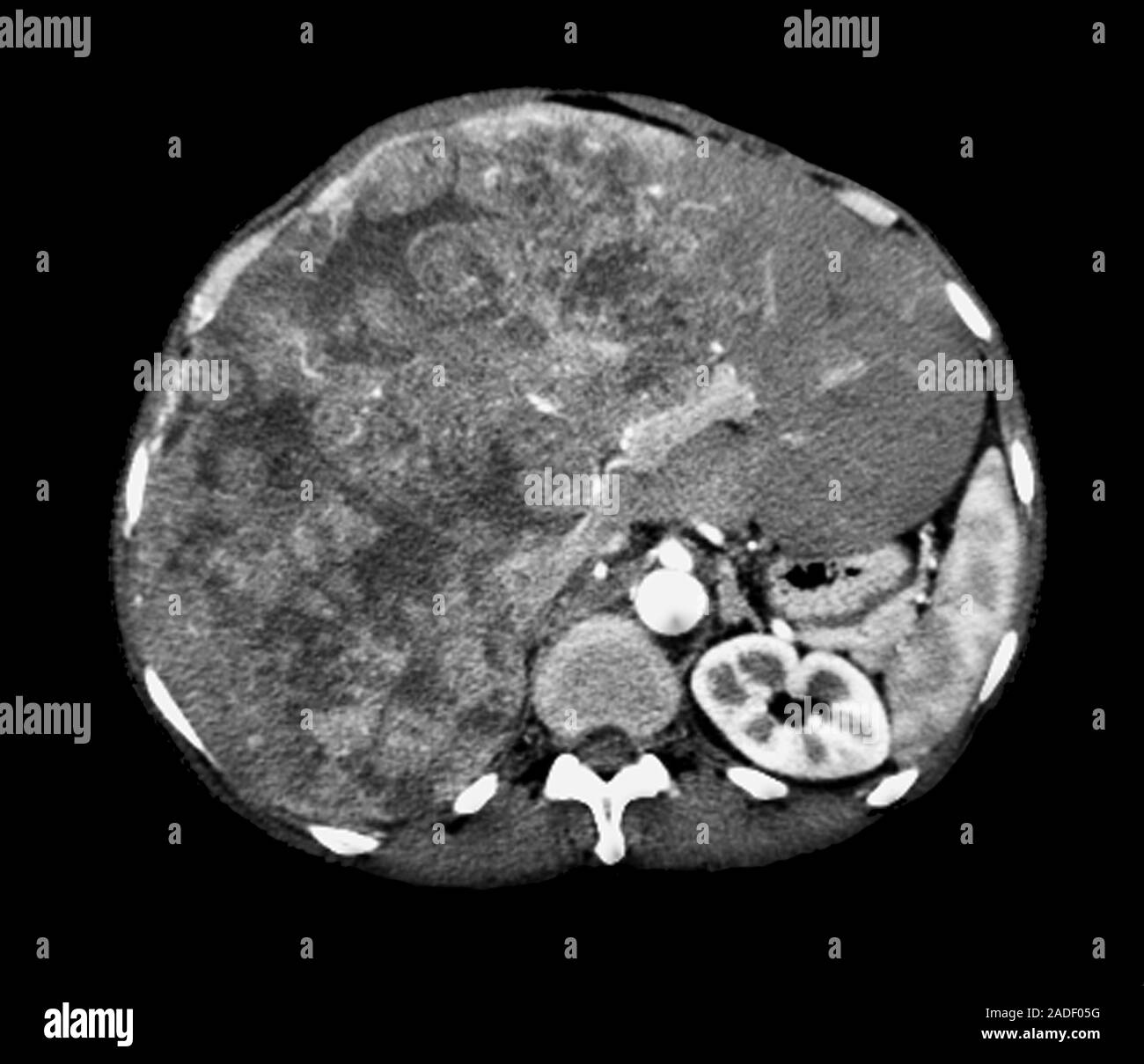 Liver cancer. Computed tomography (CT) scan of a section through the abdomen of a 53-year-old ...
