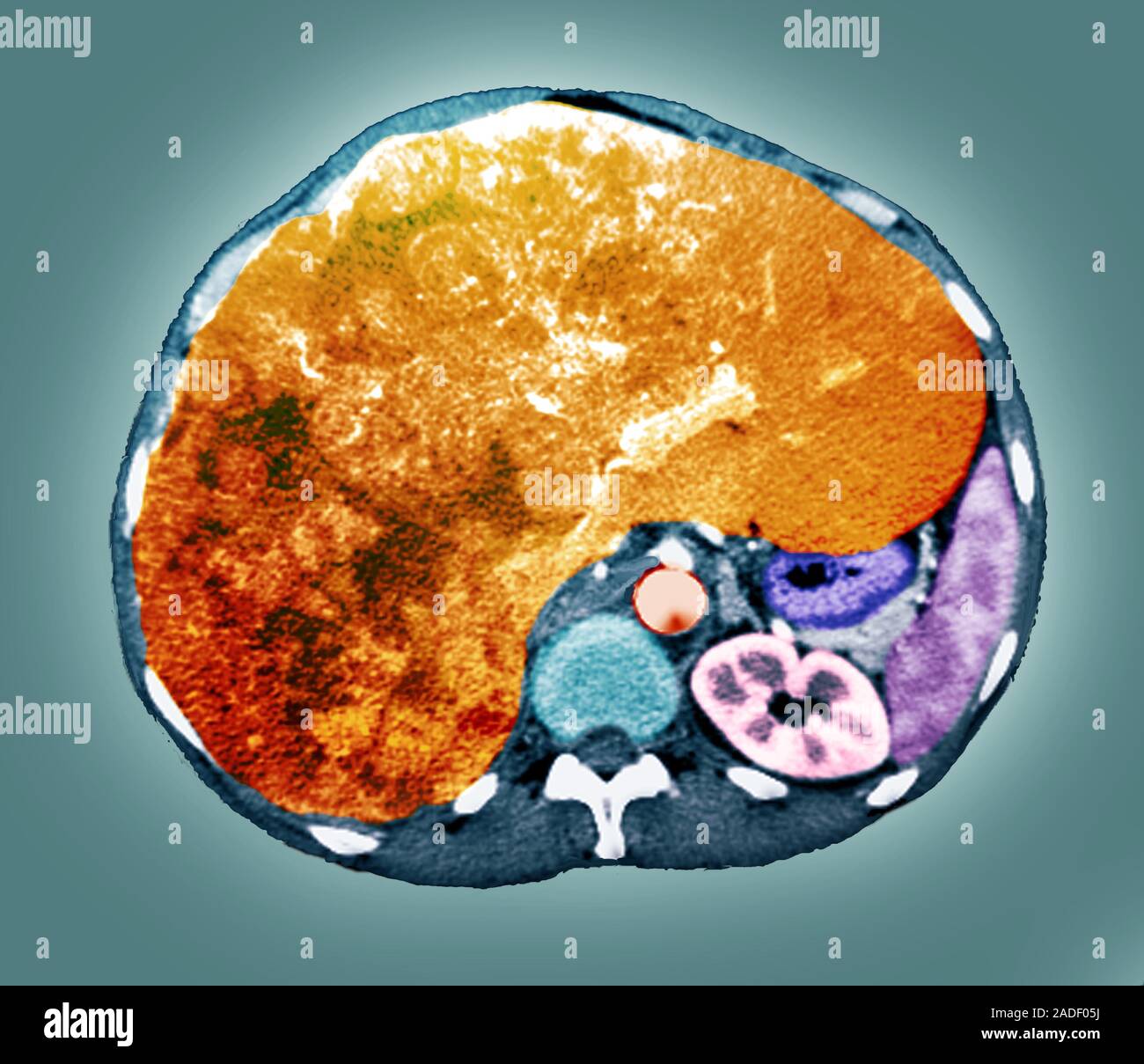 Liver cancer. Coloured computed tomography (CT) scan of a section through the abdomen of a 53 ...