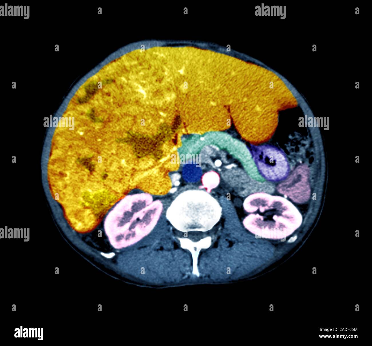 Liver cancer. Coloured computed tomography (CT) scan of a section through the abdomen of a 53 ...