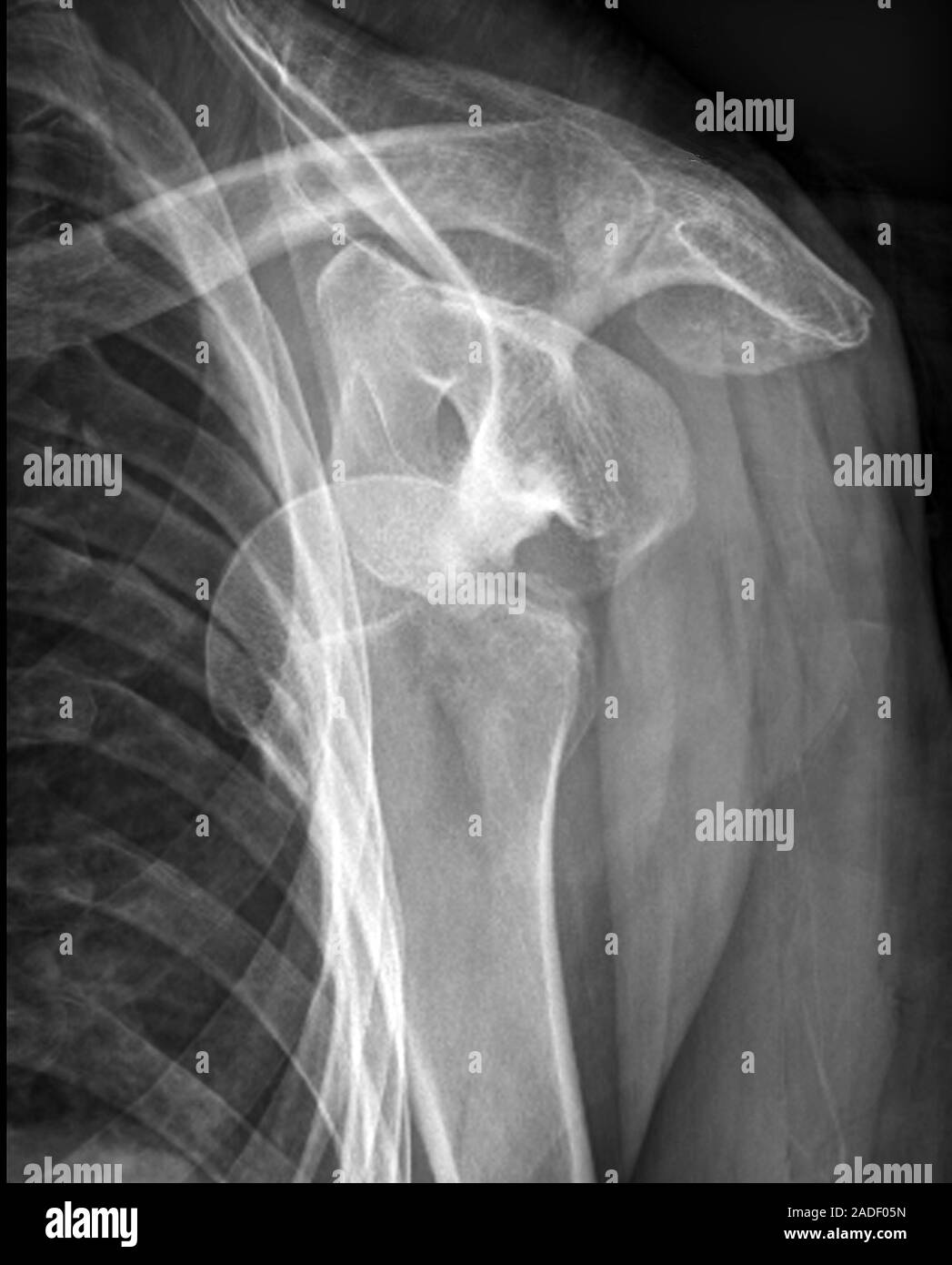 Dislocated shoulder. X-ray of a section through the left shoulder of a ...