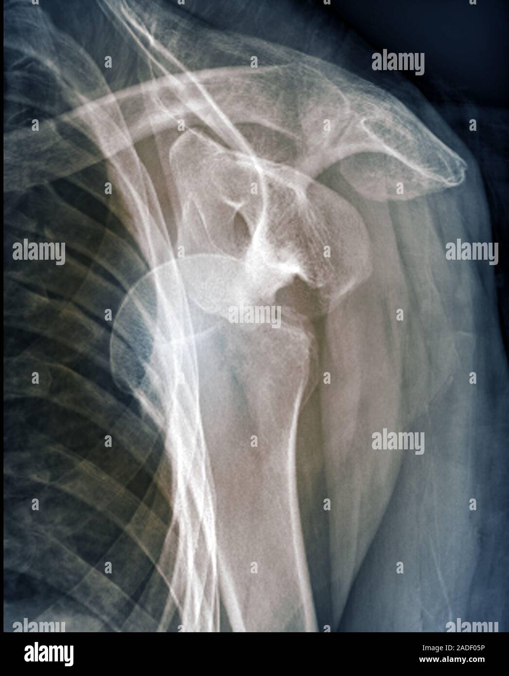 Dislocated shoulder. Coloured X-ray of a section through the left ...