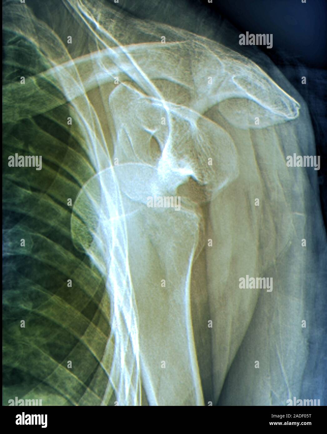 Dislocated shoulder. Coloured X-ray of a section through the left ...