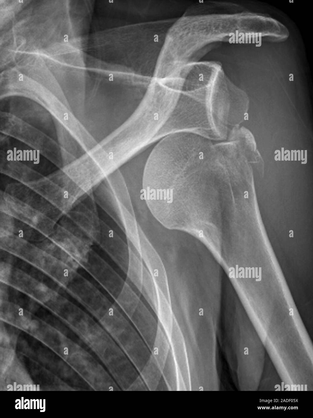Dislocated shoulder. X-ray of a section through the left shoulder of a ...