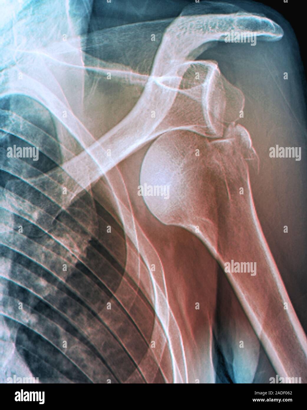 Dislocated shoulder. Coloured X-ray of a section through the left ...