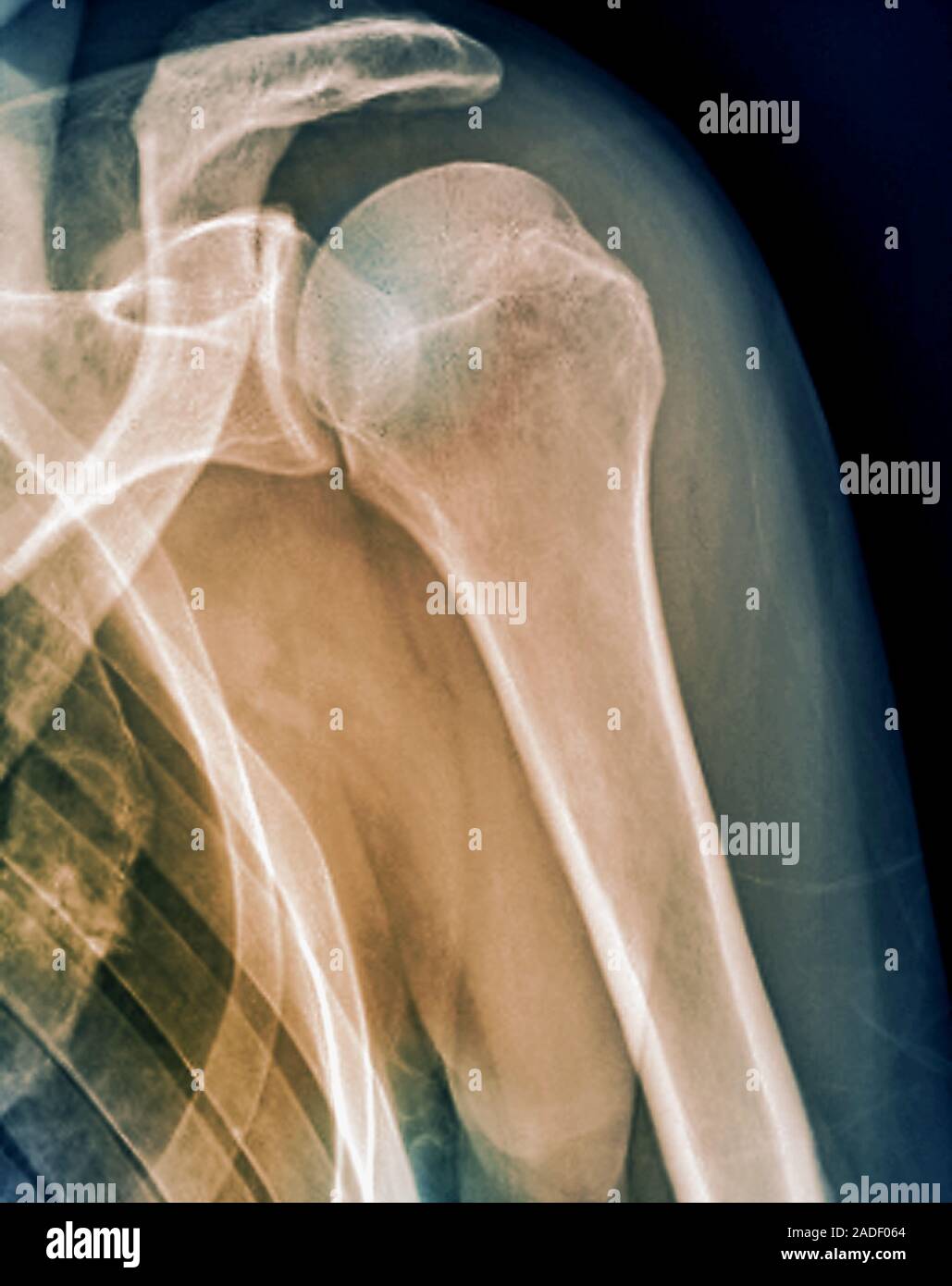 Dislocated shoulder. Coloured X-ray of a section through the left ...