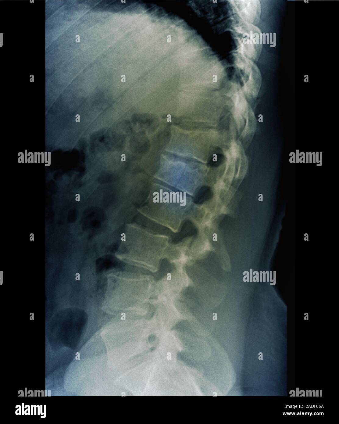 Spinal fracture. Coloured X-ray of a section through the lumbar spine ...