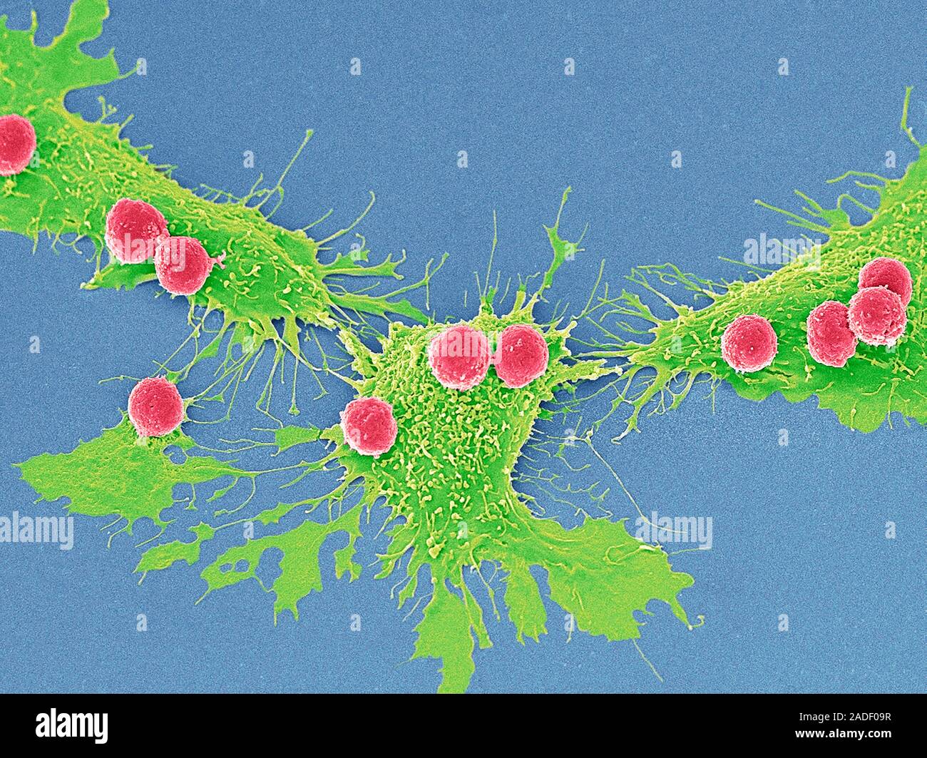 T lymphocytes and cancer cells. Coloured scanning electron micrograph ...