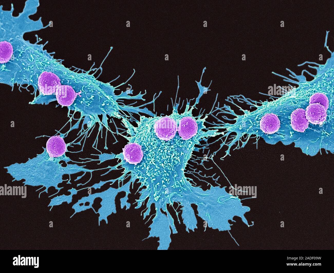 T lymphocytes and cancer cells. Coloured scanning electron micrograph ...