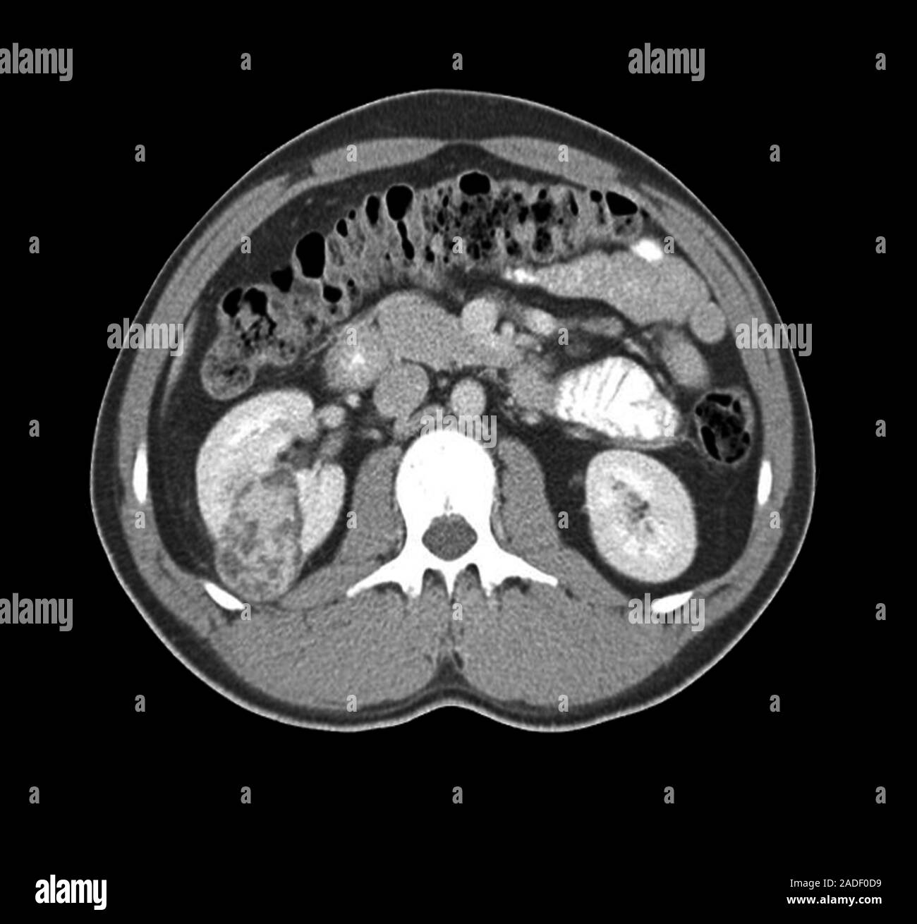 Renal cancer. Computed tomography (CT) scan of an axial section of the ...