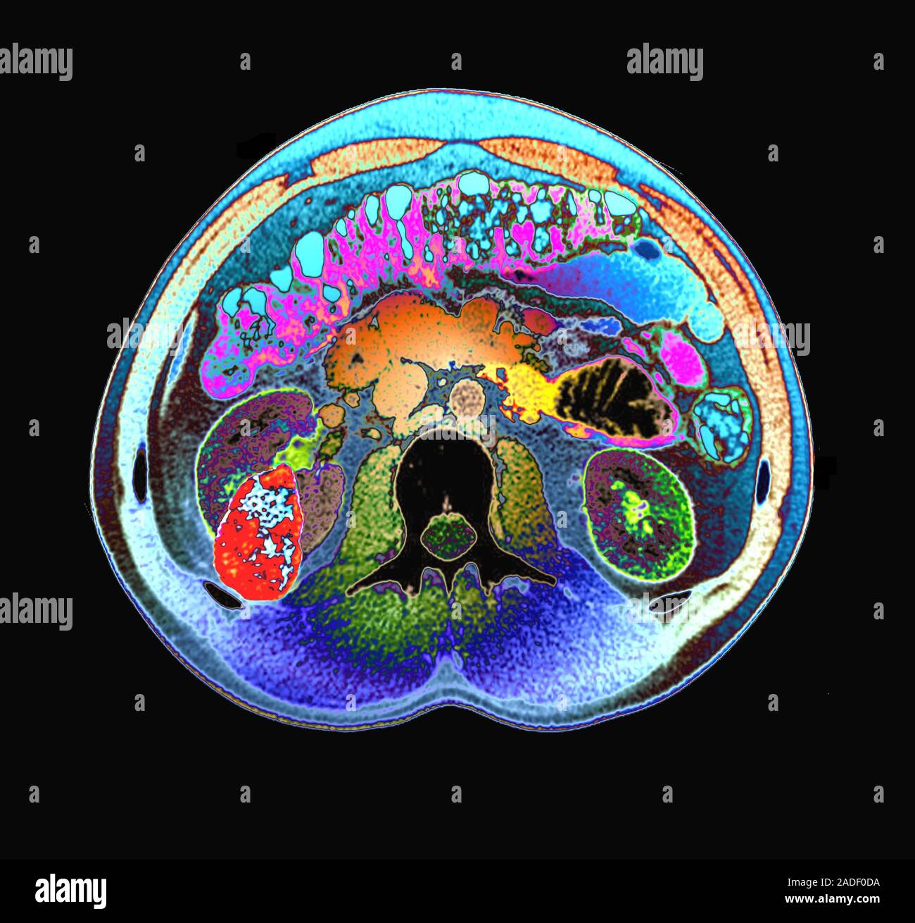 Renal cancer. Coloured computed tomography (CT) scan of an axial section of the abdomen of a 57 ...